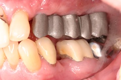 Fixed Implant Restoration San Ramon CA, Renu Prosthodontics