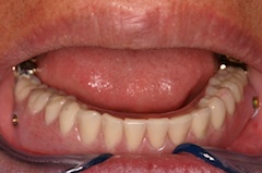 Removable Implant Overdenture San Ramon CA, Renu Prosthodontics